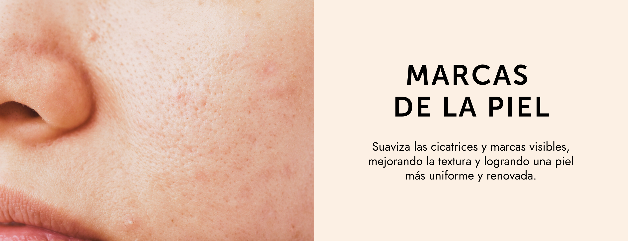 MARCAS DE LA PIEL – San Benita